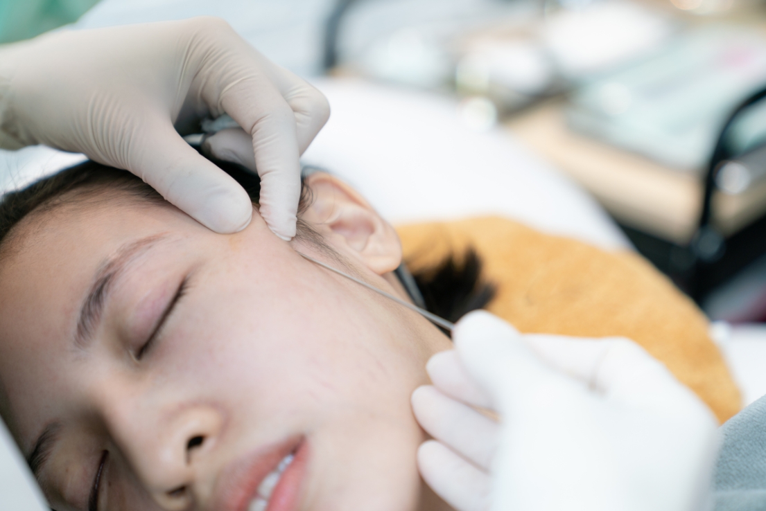 The Key Benefits Of Regenerative PRF Treatment